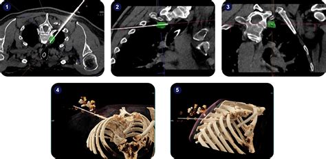 Micromate™ Case Report Robotic Assisted Ct Guided Lung Biopsy