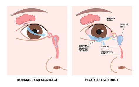 Firma Vacunación Oxido Blocked Tear Duct Treatment Grillo Primero Enredo