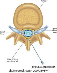 Medical Illustration Epidural Anesthesia Isolated On Stock Vector