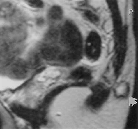 Pilonidal Cyst Mri
