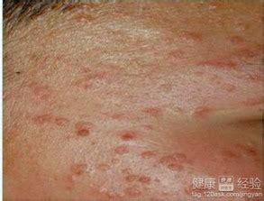 丹毒症状 随意云