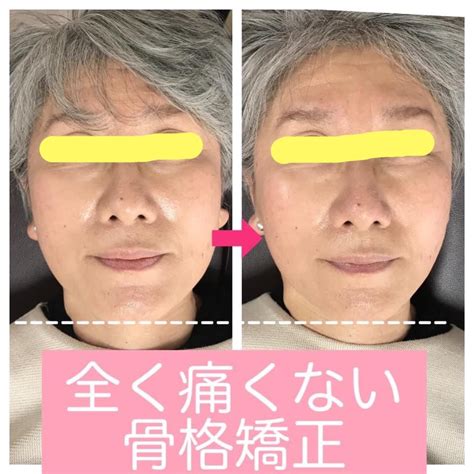 エラ張り顔をつくりだす食いしばりの影響を知り改善【豊中市aiyuru】 大阪・豊中市さとう式リンパケア施術サロンaiyuru＊骨格矯正