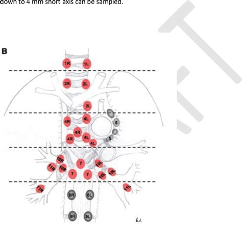 Lymph Node Stations Accessible By Transbronchial Needle Aspiration Are Download Scientific