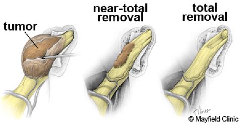 Figure 3 From Suboccipital Surgery For Acoustic Neuroma Semantic Scholar