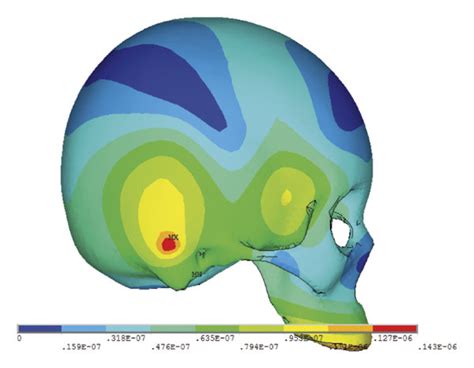 Magnitude Of Displacement Of Surface Nodes On The Ipsilateral And Download Scientific Diagram
