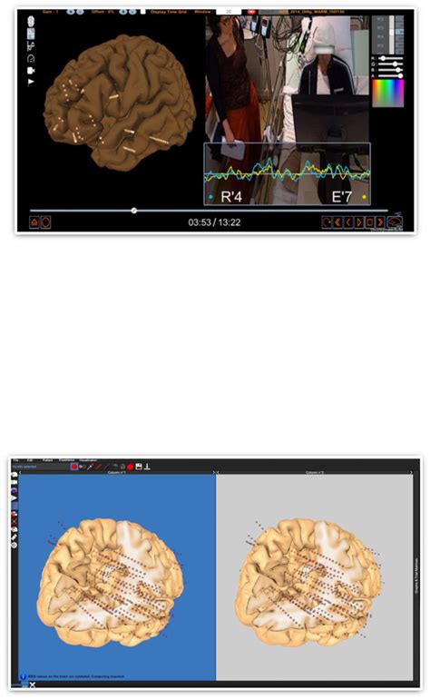 Hibop Picture Of The Human Intracranial Brain Observation Player Download Scientific Diagram
