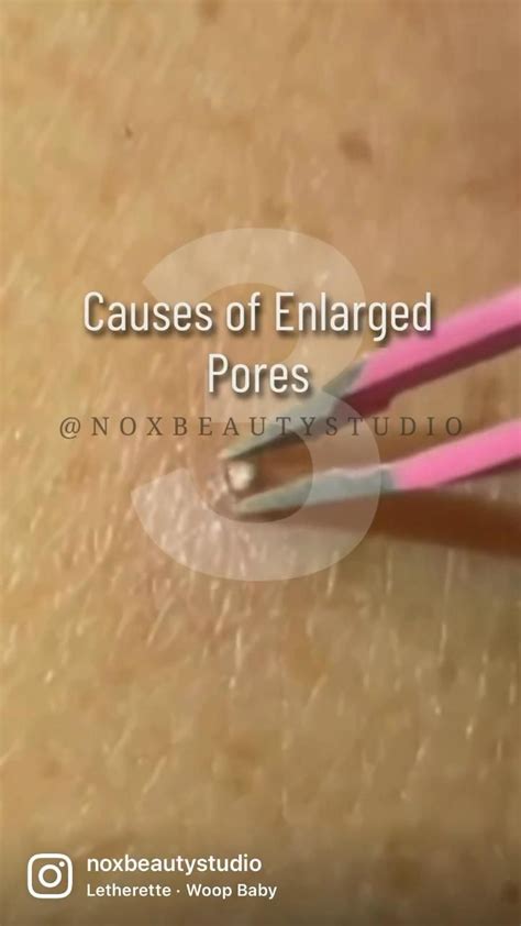 3 Causes Of Enlarged Pores Video Body Exfoliator Skin Care Routine