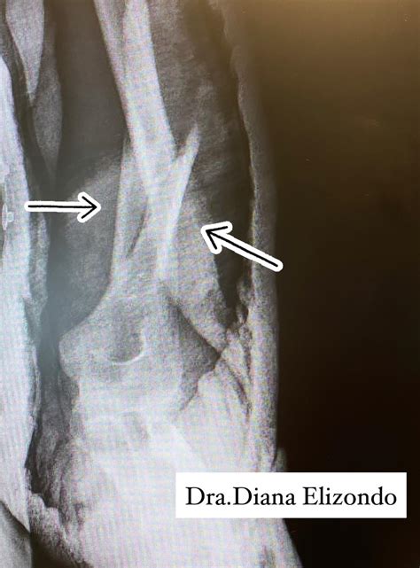 Dra Diana Elizondo On Linkedin The Fearsome Holstein Lewis Fracture