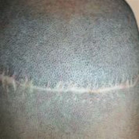 View Of Scalp Hair Demonstrating Follicular Units These Are Naturally