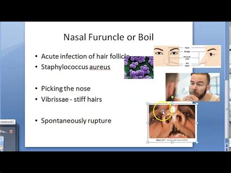Staphylococcus Aureus Infection In Nose