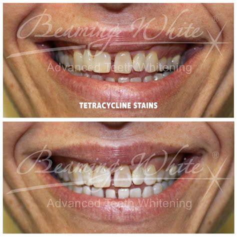 Teeth Whitening Before And After Stains