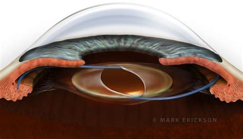 Sulcus Iol Is Positioned In The Ciliary Sulcus