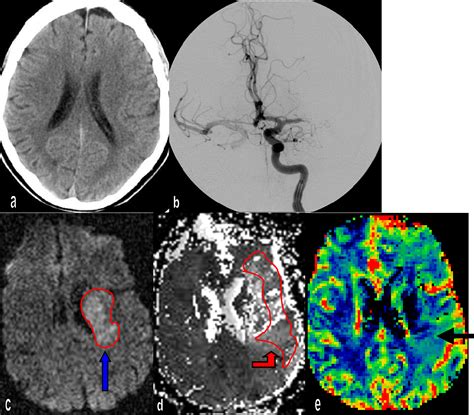 Figure 1 From Diffusion And Perfusion Weighted Magnetic Resonance Imaging In Patients With