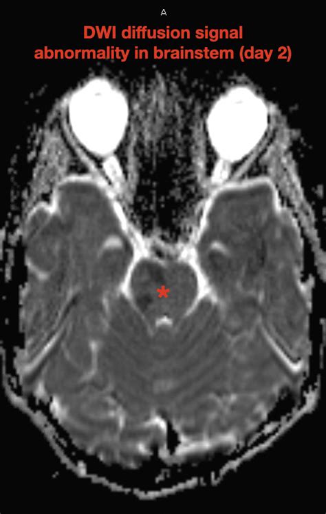 Pediatric Autoimmune Encephalitis Dwi Diffusion Signal Abnormality In