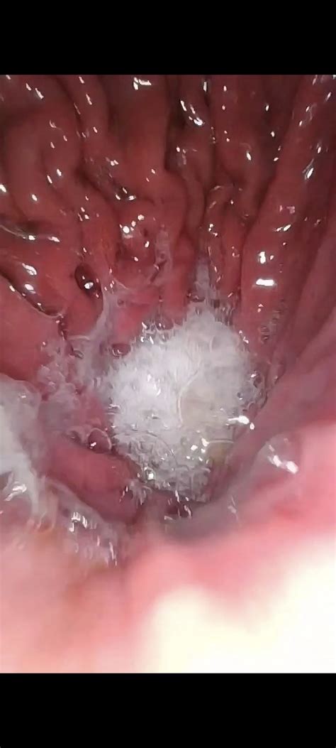 Chinese Girl Endoscope Thisvid Com En Espa Ol