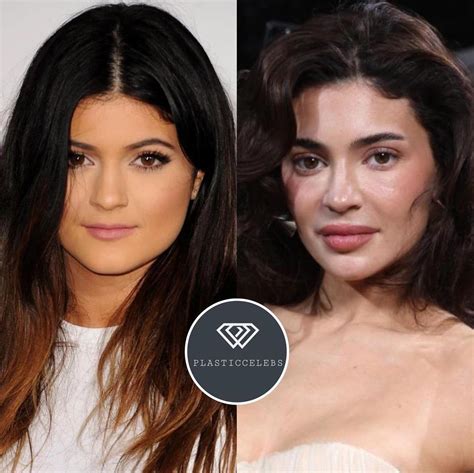 Kylie Jenner Lips Before And After