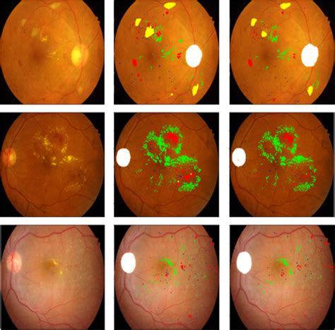 Segmentation Results Of Few Retinal Images From IDRiD Dataset A Input Download Scientific
