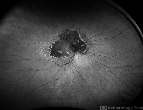 Geographic Atrophy Retina Image Bank