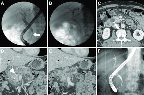 Plastic Stent Insertion For An Intrapancreatic Common Bile Duct Cbd