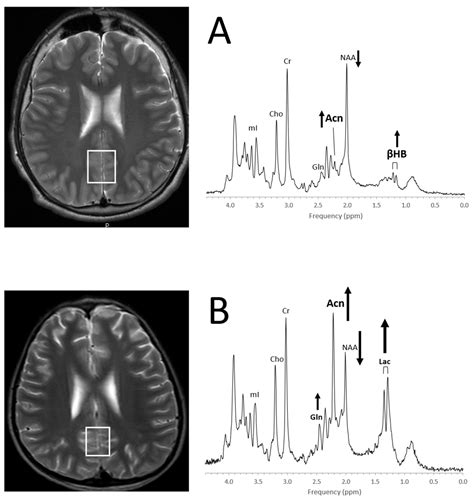 Spectroscopy Mri Radiology At Carolyn Bey Blog