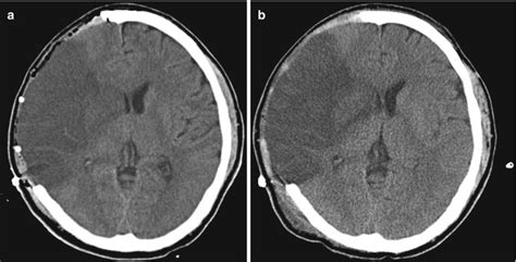Decompressive Hemicraniectomy For Malignant Hemispheric Infarction Neupsy Key