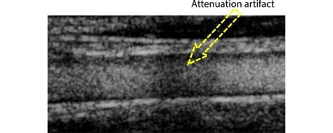 imaging artefact correction a pulse inversion and b corrected