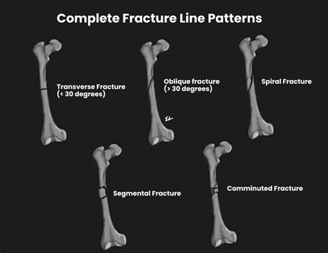 Introduction To Fractures Hyperexcision