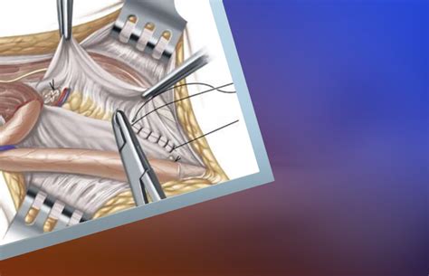 Laparoscopc Inguinal Hernia Repair Saudi German Health