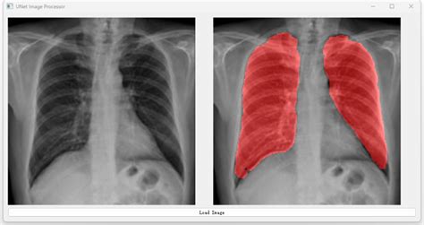 深度学习之基于unet肺部ct图像分割项目pyqt5界面 索炜达猿创
