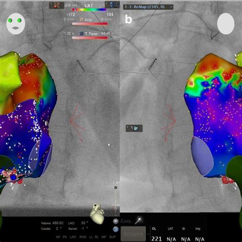 A B Intra Atrial Reentrant Tachycardia In A Patient With A Surgically Download Scientific