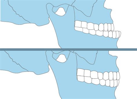Class 3 Malocclusion Treatment With Clear Aligners Treatment Plan