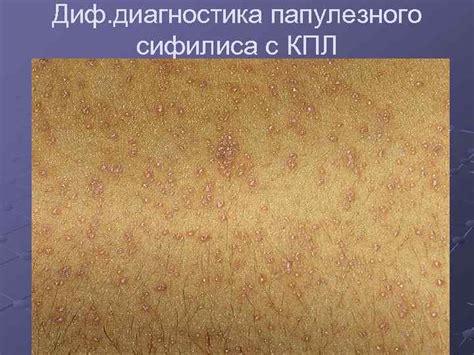 Первичный и вторичный сифилис Бледная трепонема