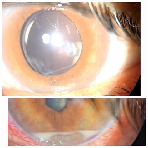 Aziz Qurban On Linkedin Treated A Complicated Case Of Hypopyon Ulcer Of A Patient Underwent…