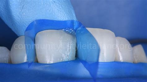 Easy Way To Enhance Aesthetics With Simplified Composite Shades