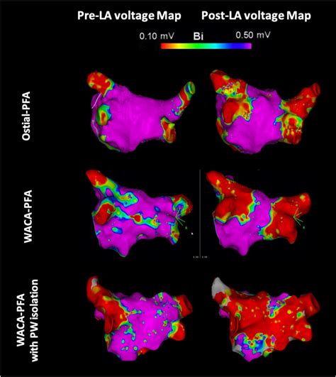 Pre And Post Ablation Left Atrial Voltage Maps In Posterioranterior