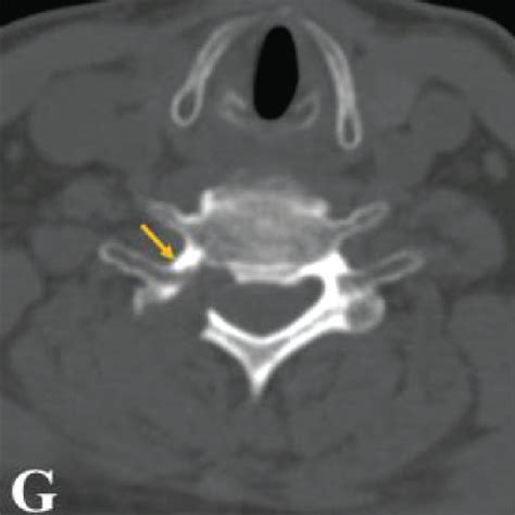 A Sagittal Mri Scan Showing A Severe Compression Of The C5 C6