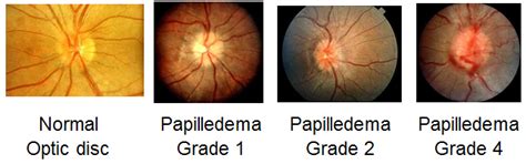 Papilledema Medical Pictures Medical Picture