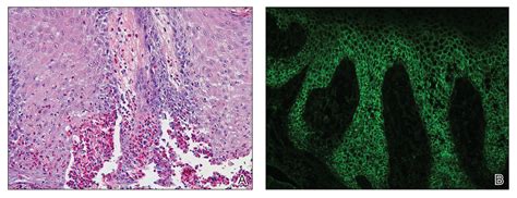 Cutaneous Pemphigus Vegetans Co Occurring With Oral Pemphigus Vulgaris