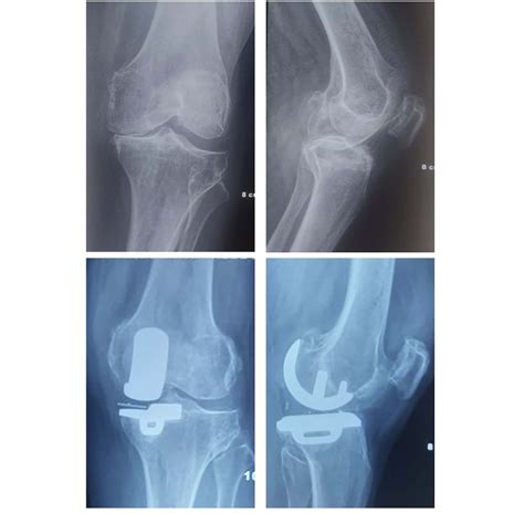 Pre And Post Operative Radiographs Of Oxford Mobile Bearing Uka For