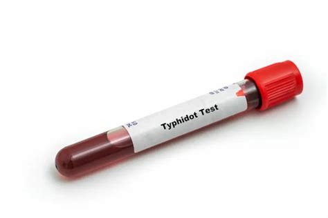 Typhidot Test Overview And Procedures
