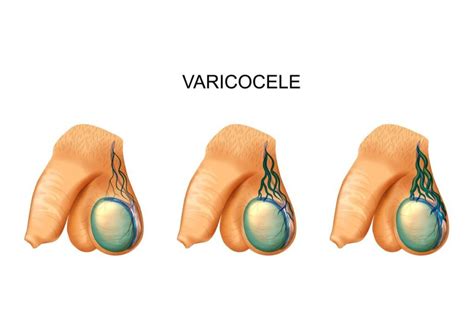 Varicocele Grades And Treatment Needed Plan B Wellness
