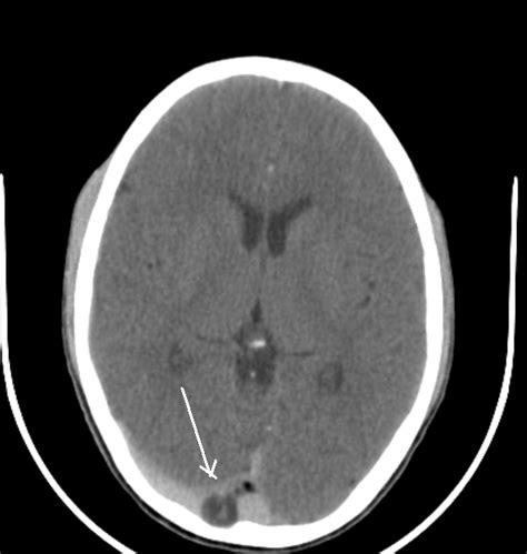 Giant Arachnoid Granulation Sumers Radiology Blog