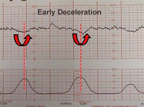 Confused About Variability Decelerations Ob Gyn Nursing