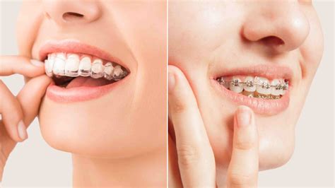 Teeth Aligners Vs Braces Heres 5 Things To Consider