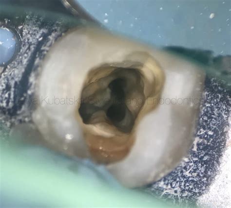 Danger Zone In C Shaped Root Canals Style Italiano Endodontics