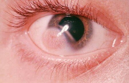 Limbal Dermoid Cyst Eye