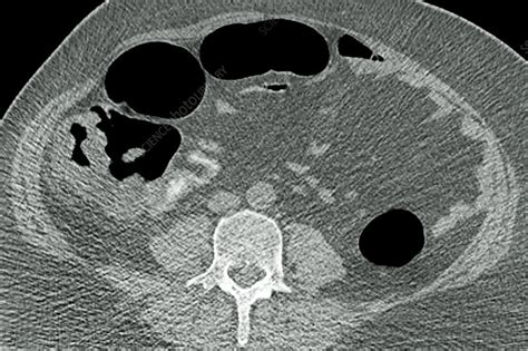 Colon Cancer Ct Scan Stock Image C039 3989 Science Photo Library