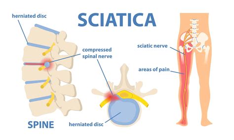 What Does Sciatica Feel Like Blog Boroondara Osteopathy