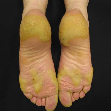 Hyperkeratosis Definition Causes Prognosis And Hyperkeratosis Treatment
