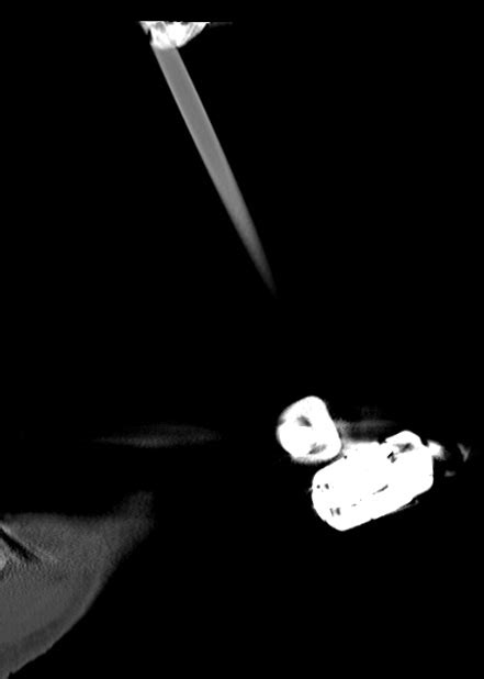 Chopart Fracture Radiopaedia 35347 36861 Sagittal Bone Window Nc Commons